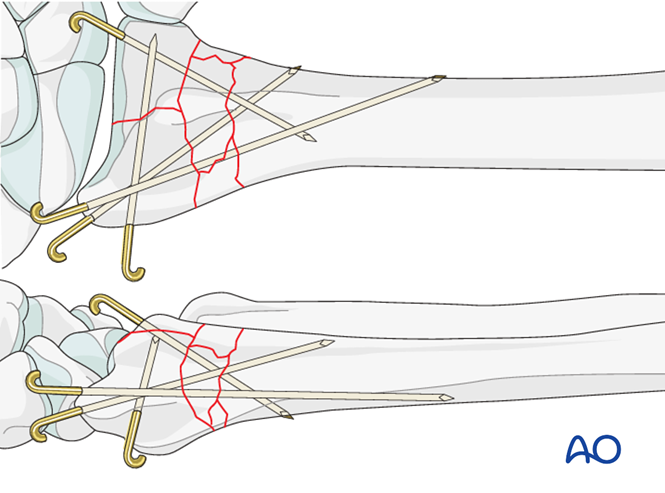 Closed reduction - K-wires and cast/external fixator for Complete ...