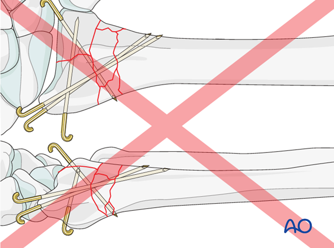 Closed reduction - K-wires and cast/external fixator for Complete ...
