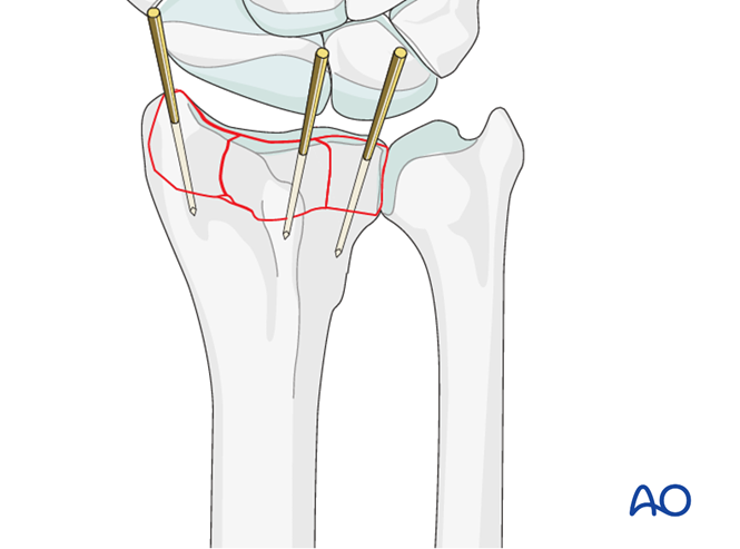 ORIF - Dorsal double plate for Partial articular fracture of the radius ...