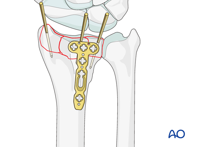 ORIF - Dorsal double plate for Partial articular fracture of the radius ...
