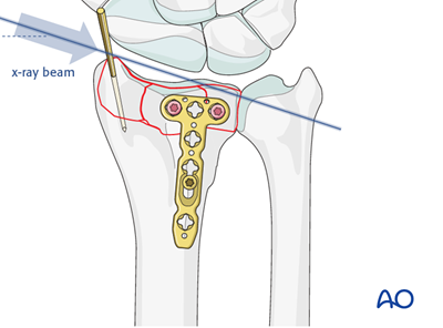 ORIF - Dorsal double plate for Partial articular fracture of the radius ...