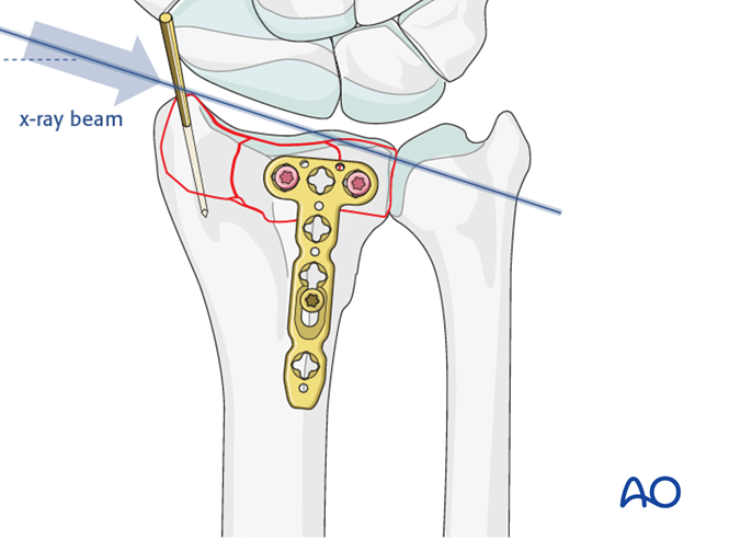 ORIF - Dorsal double plate for Partial articular fracture of the radius ...