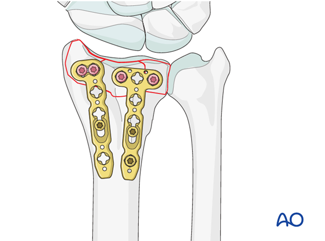 ORIF - Dorsal double plate for Partial articular fracture of the radius ...