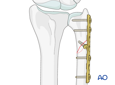 ORIF - Lag screw and protection plate for Extraarticular simple ...