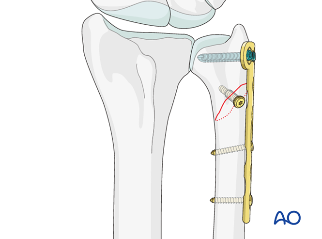 ORIF - Lag screw and protection plate for Extraarticular simple ...