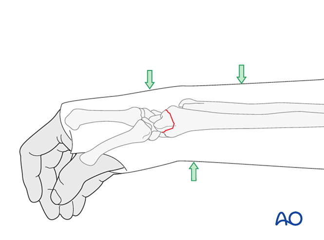 Nonoperative treatment - Cast for Partial articular, simple fracture of ...