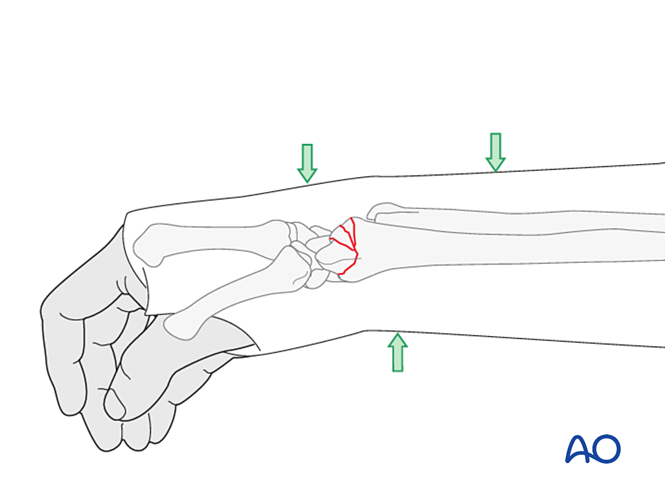 Nonoperative treatment - Cast for Partial articular, fragmentary ...