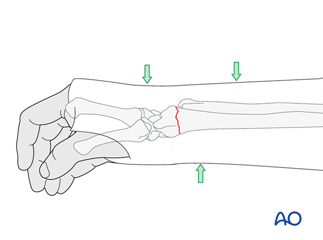 Nonoperative treatment - Cast for Extraarticular fracture of the radius ...