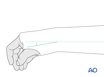 Nonoperative treatment - Cast for Partial articular, simple fracture of ...