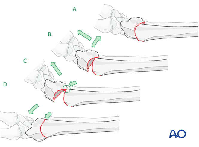 Nonoperative treatment - Cast for Extraarticular fracture of the radius ...