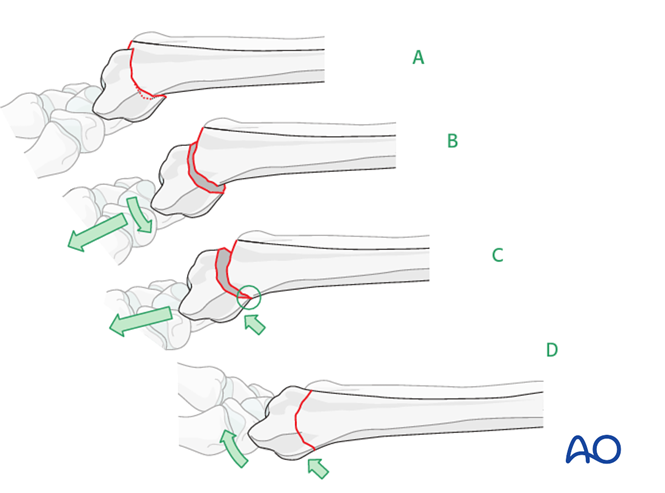 Nonoperative treatment - Cast for Extraarticular fracture of the radius ...