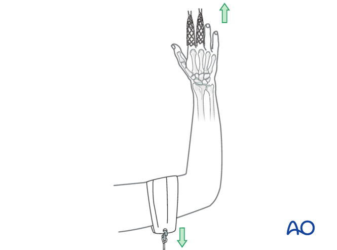 Nonoperative treatment - Cast for Extraarticular fracture of the radius ...