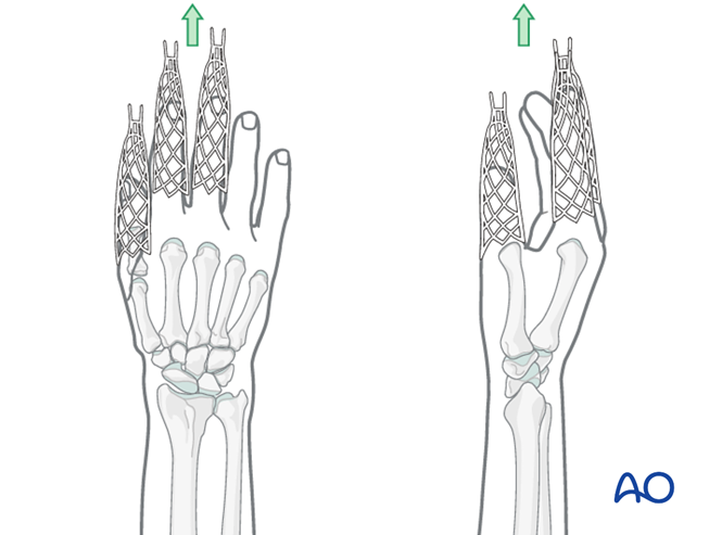 Nonoperative treatment - Cast for Extraarticular fracture of the radius ...