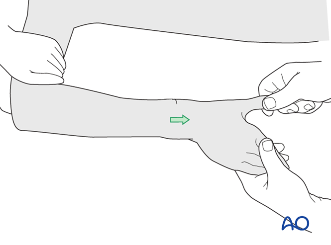 Nonoperative treatment - Cast for Complete simple articular, simple ...