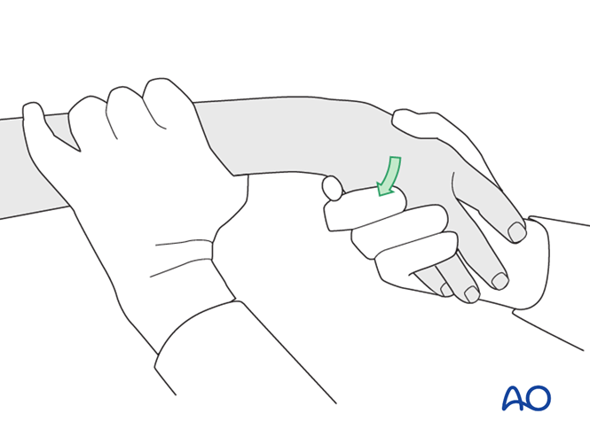Nonoperative treatment - Cast for Partial articular, sagittal ...