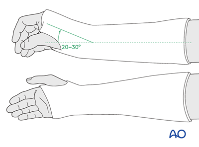 Casting of the wrist and forearm