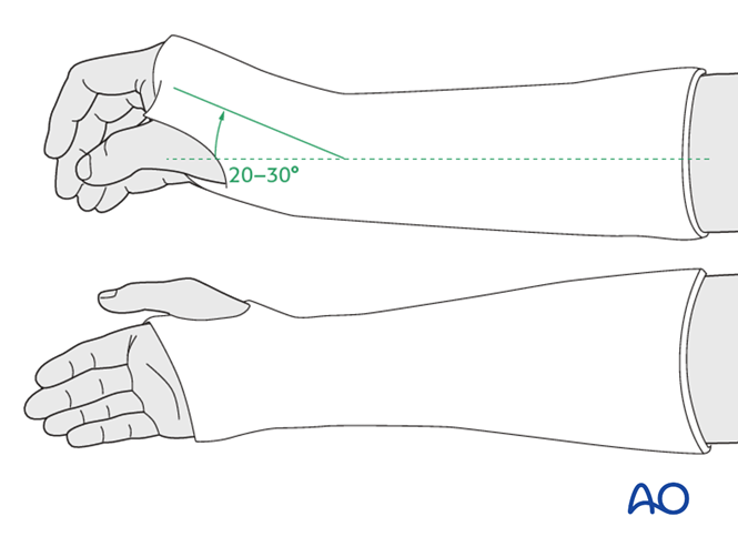 Nonoperative treatment - Cast for Extraarticular fracture of the ulnar ...