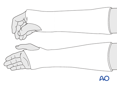 Nonoperative treatment - Cast for Extraarticular fracture of the radius ...