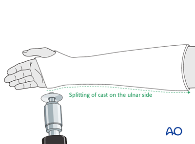 Casting of the wrist and forearm