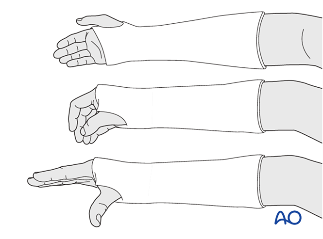 Nonoperative treatment - Cast for Extraarticular fracture of the radius ...