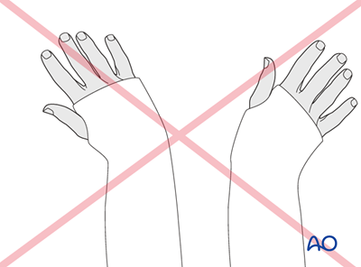 Nonoperative treatment - Cast for Extraarticular simple fracture of the ...