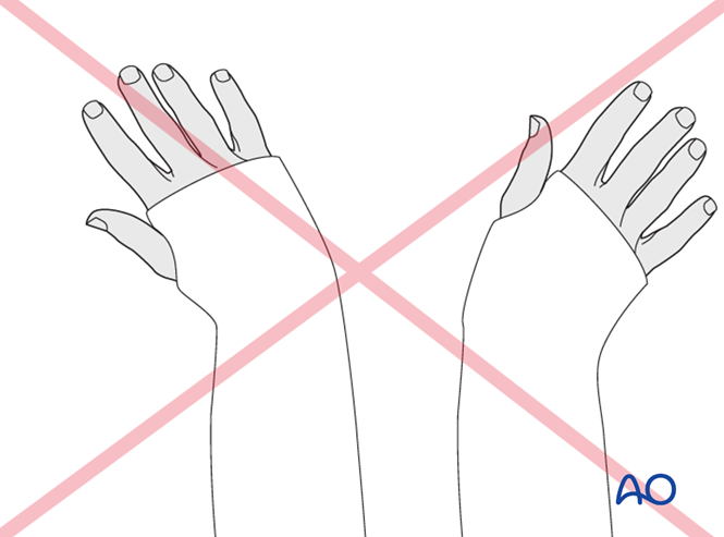 Nonoperative treatment - Cast for Extraarticular simple fracture of the ...