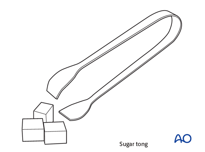 Nonoperative treatment - Cast for Extraarticular simple fracture of the ...