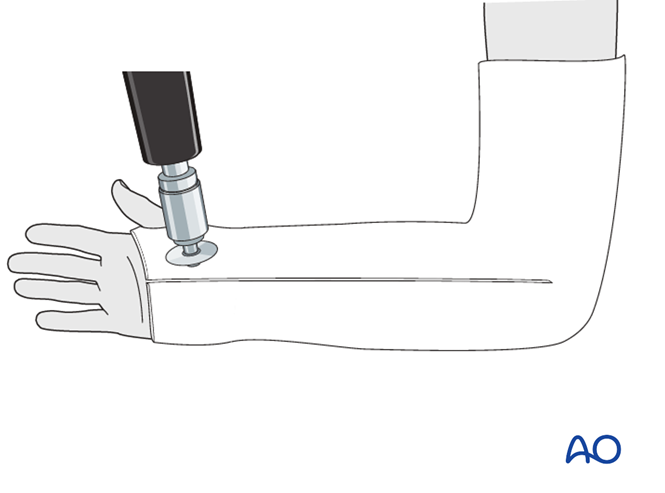 Nonoperative treatment - Cast for Extraarticular multifragmentary ...