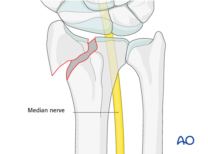 ORIF - Radial column plate for Partial articular, sagittal simple ...
