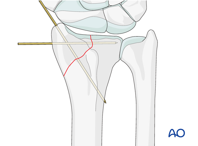 Closed reduction - Lag screws for Partial articular, sagittal simple ...