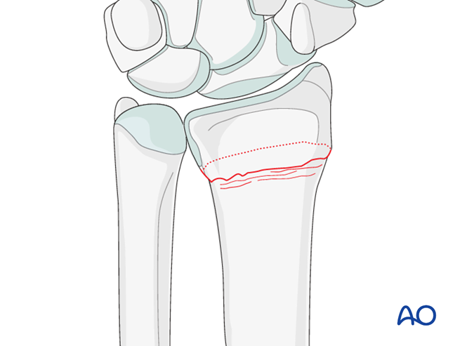 ORIF - Palmar plate for Extraarticular undisplaced fracture of the radius