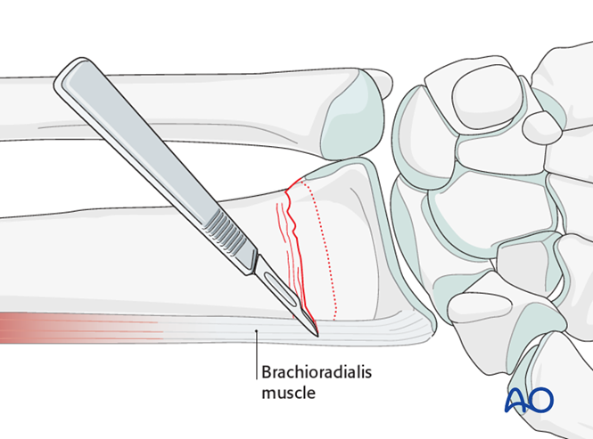 ORIF - Palmar plate for Extraarticular undisplaced fracture of the radius