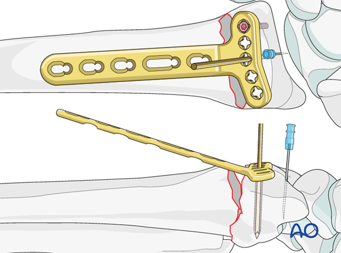 ORIF - Palmar plate for Extraarticular fracture of the radius with ...