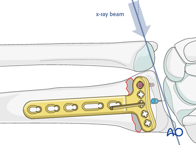 ORIF - Palmar plate for Extraarticular fracture of the radius with ...