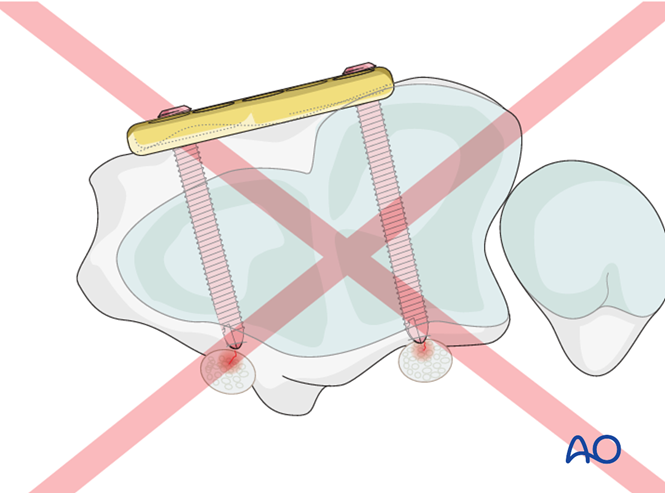 ORIF - Palmar plate for Extraarticular fracture of the radius with ...