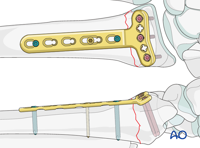 ORIF - Palmar plate for Extraarticular fracture of the radius with ...