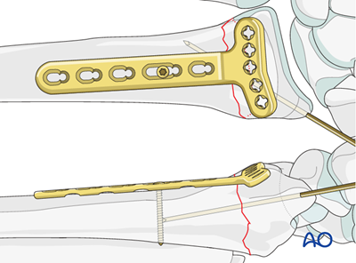 ORIF - Palmar plate for Extraarticular fracture of the radius with ...
