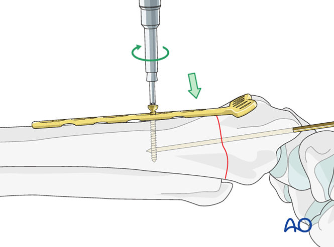 ORIF - Palmar plate for Extraarticular fracture of the radius with ...