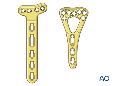 ORIF - Palmar plate for Complete simple articular, simple metaphyseal ...