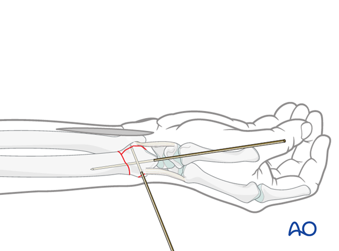 ORIF - Palmar plate for Complete simple articular, simple metaphyseal ...