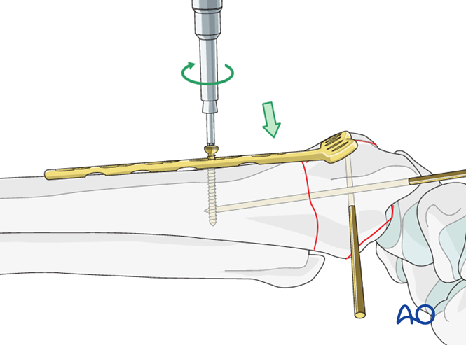 ORIF - Palmar plate for Complete simple articular, simple metaphyseal ...