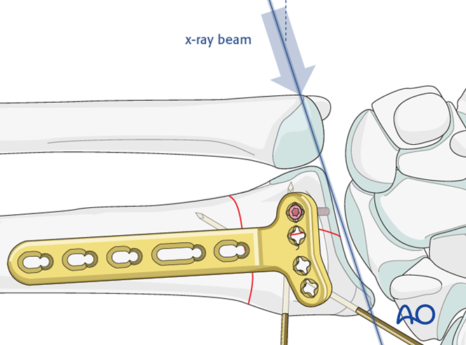 ORIF - Palmar plate for Complete simple articular, simple metaphyseal ...