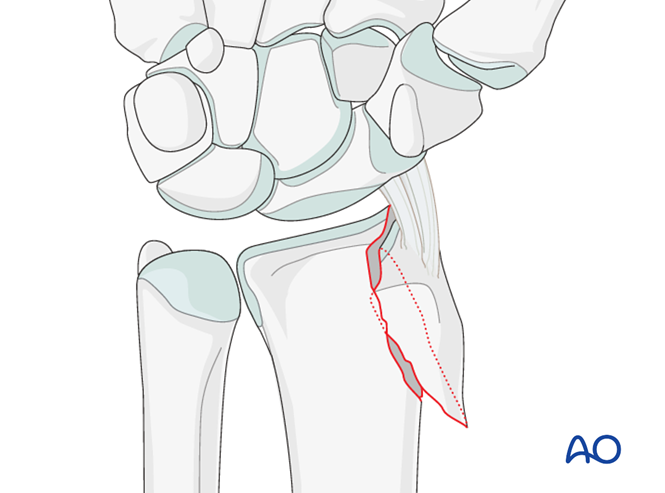 ORIF - Palmar plate for Partial articular, sagittal simple radial ...