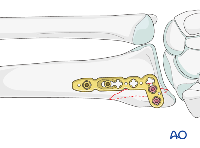 ORIF - Palmar plate for Partial articular, sagittal simple radial ...