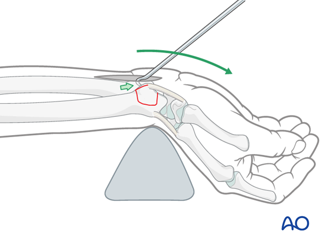 ORIF - Palmar plate for Partial articular fracture of the radius ...