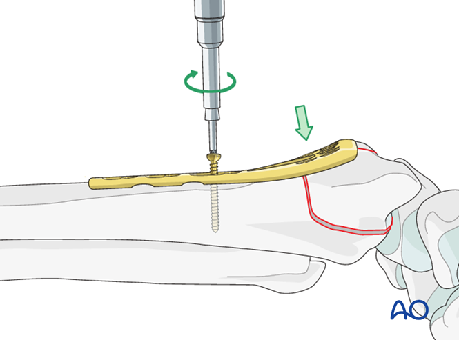 ORIF - Palmar plate for Partial articular fracture of the radius ...