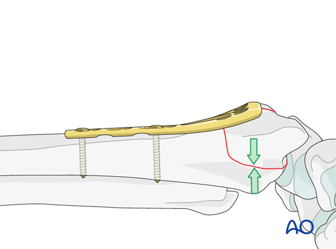 ORIF - Palmar plate for Partial articular fracture of the radius ...