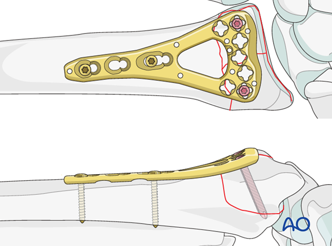 ORIF - Palmar plate for Partial articular fracture of the radius ...
