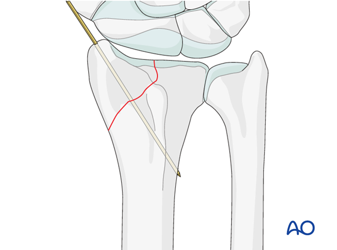 ORIF - Radial column plate for Partial articular, sagittal simple ...