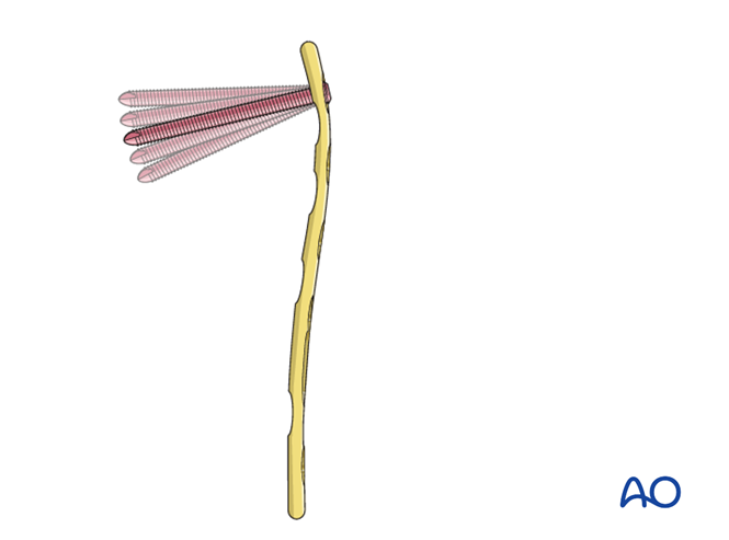 ORIF - Radial column plate for Partial articular, sagittal ...